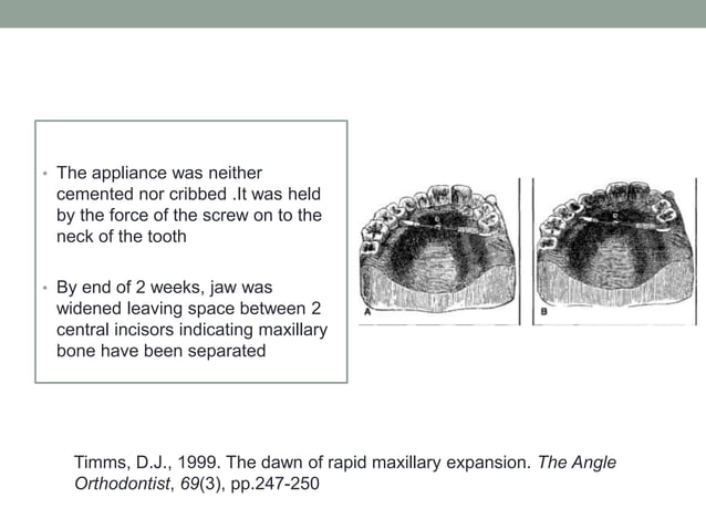 RAPID MAXILLARY EXPANSION VS SLOW MAXILLARY EXPANSION | PPTX