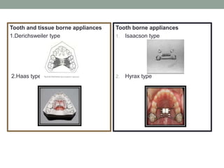 Hyrax Appliance Rapid Maxillary Expansion