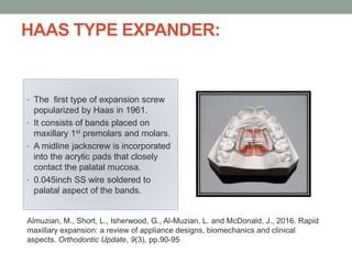 Hyrax Appliance Rapid Maxillary Expansion