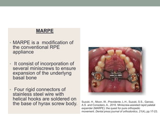 Hyrax Appliance Rapid Maxillary Expansion