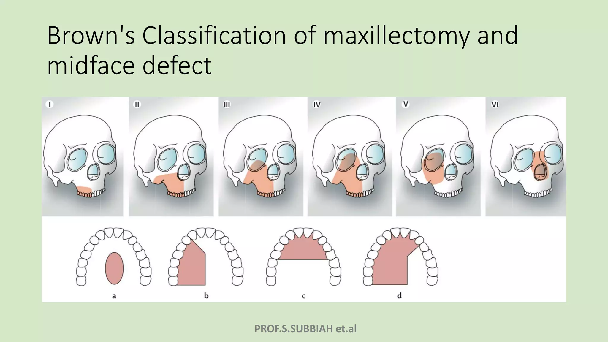 MAXILLECTOMY | PPTX