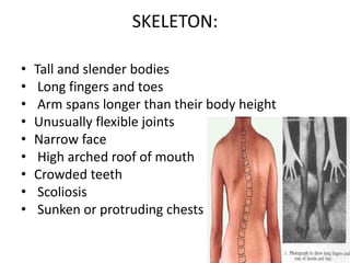 4.marfansyndrome | PPTX
