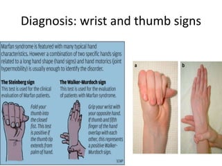 4.marfansyndrome | PPTX