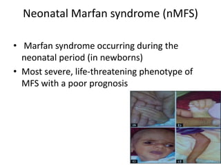 4.marfansyndrome | PPTX