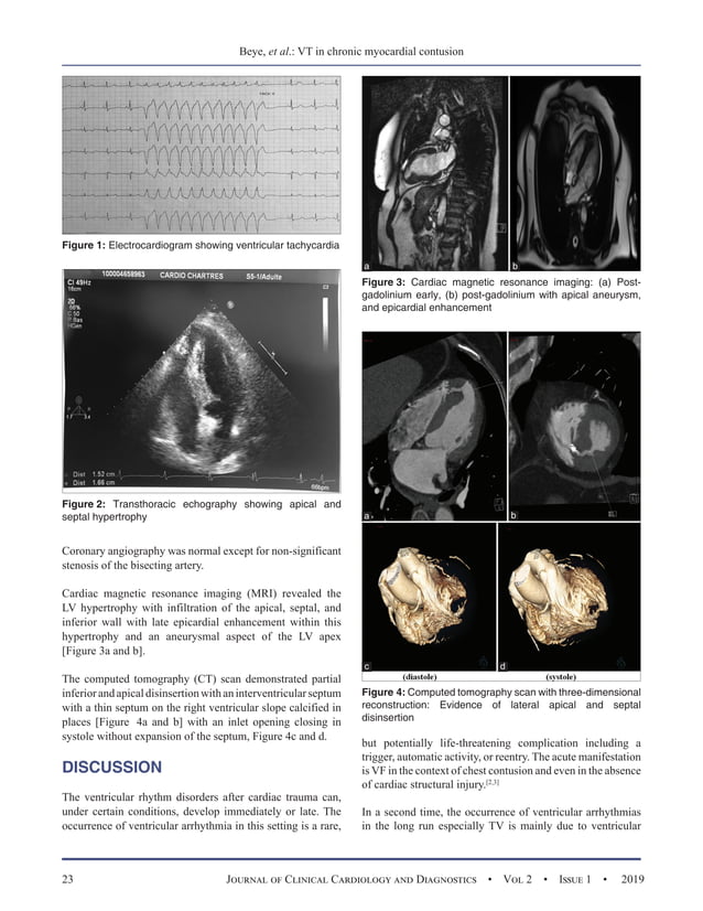 Ventricular Tachycardia in Chronic Myocardial Contusion Interest of ...
