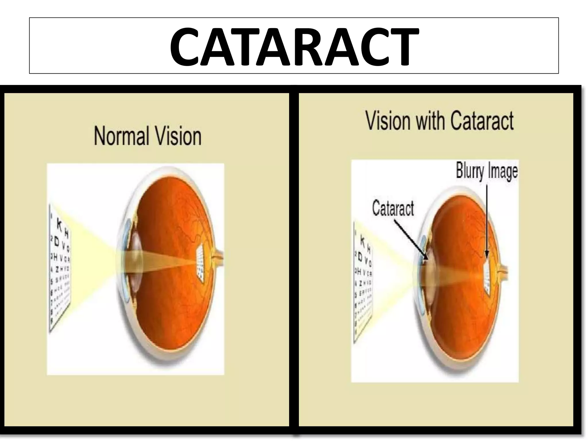 4. unit ii tm visual impairment | PPT