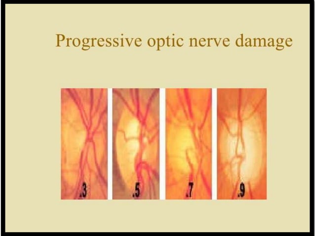 4. unit ii tm visual impairment | PPT