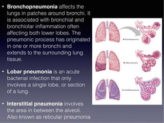 Pneumonia with case studies | PPTX
