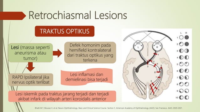 4. Retrochiasmal Lesion.pptx