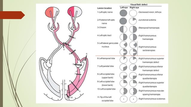 4. Retrochiasmal Lesion.pptx