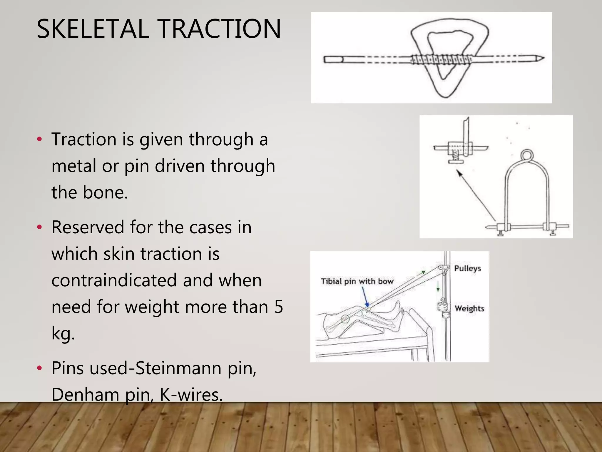TRACTION,SPLINTS AND PLASTER OF PARIS | PPTX
