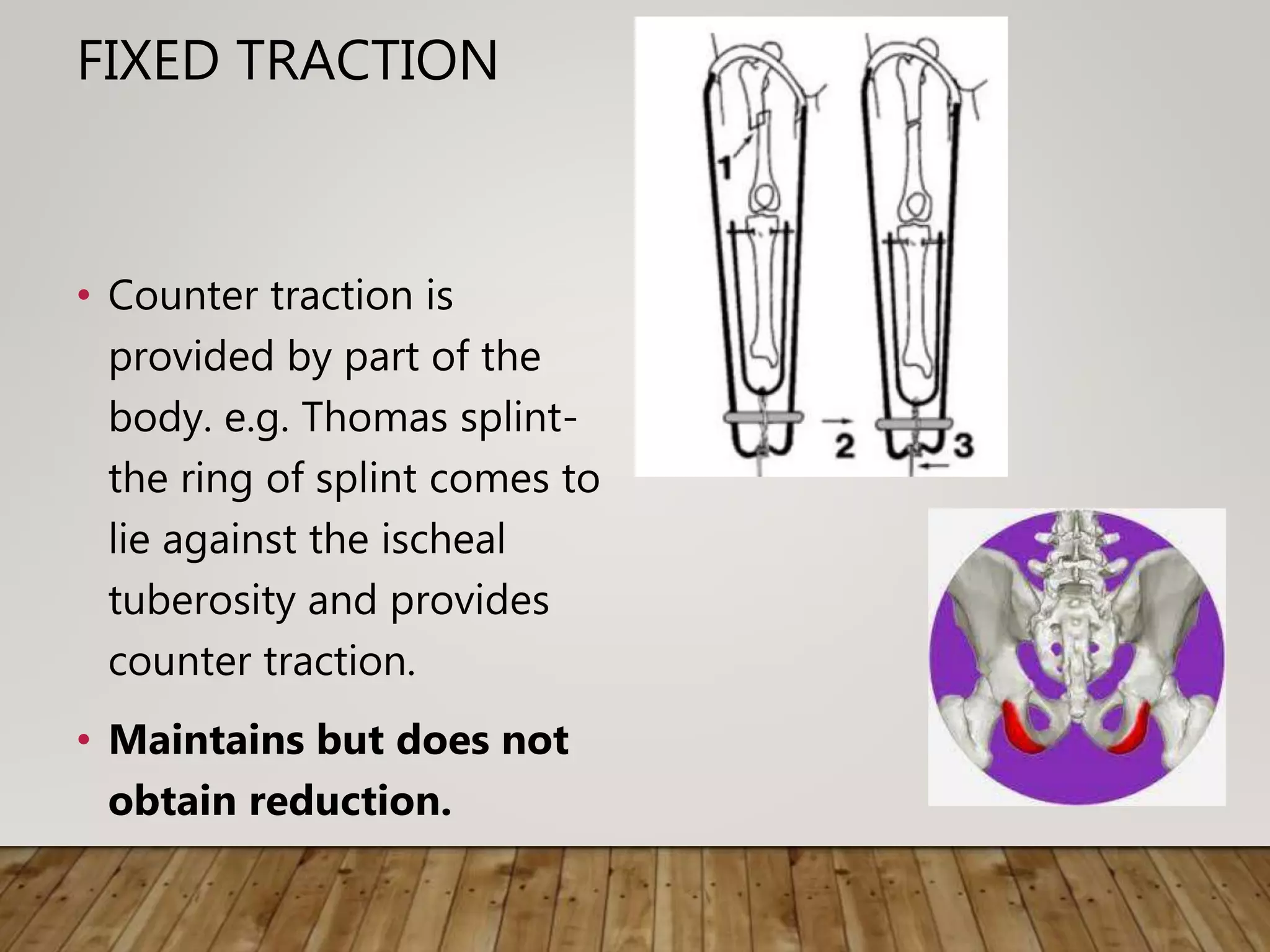 TRACTION,SPLINTS AND PLASTER OF PARIS | PPTX