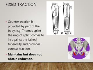 TRACTION,SPLINTS AND PLASTER OF PARIS | PPTX