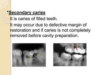 4.DISEASE OF HARD TISSUES OF TEETH.pptx