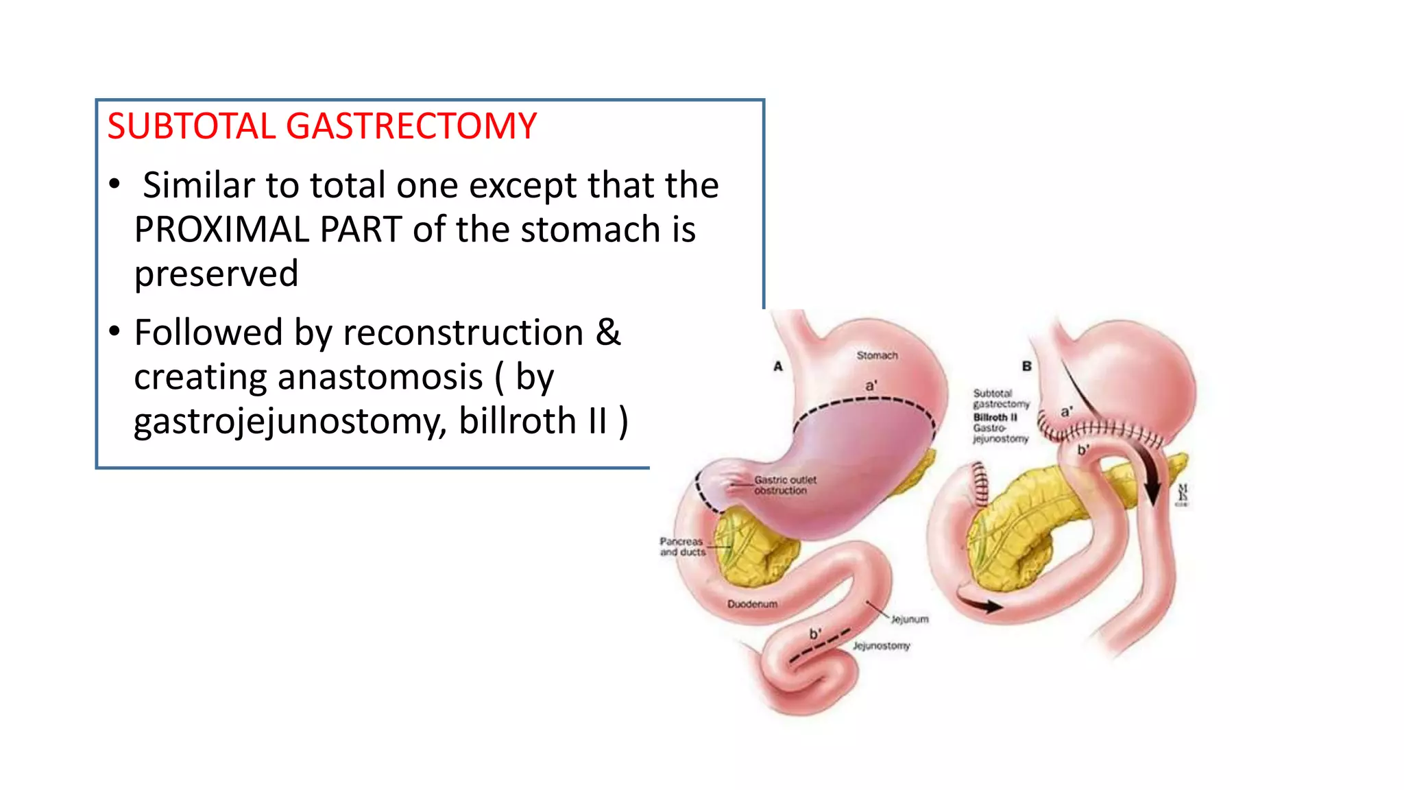 4. Gastric Cancer | PPTX