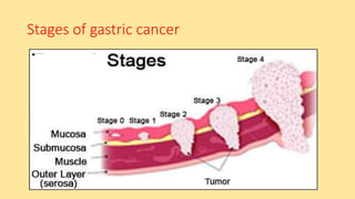 4. Gastric Cancer | PPTX
