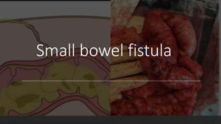 4. Small bowel fisulas & short bowel syndrome.pptx