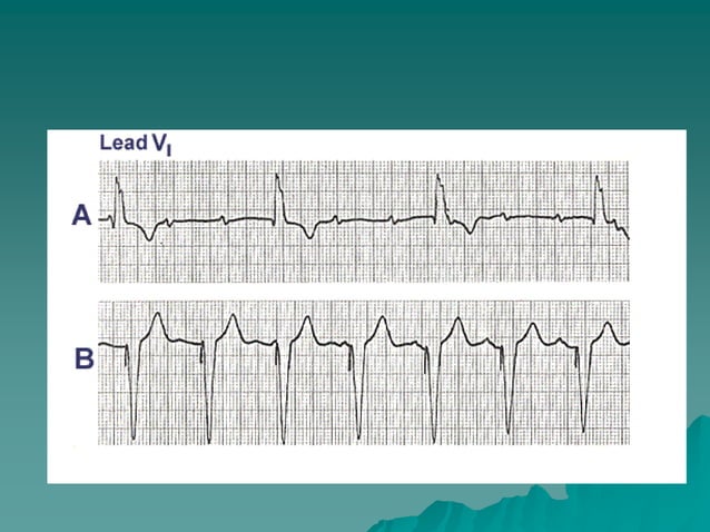 4. Cardiac conduction disturbances ppt (1).pdf