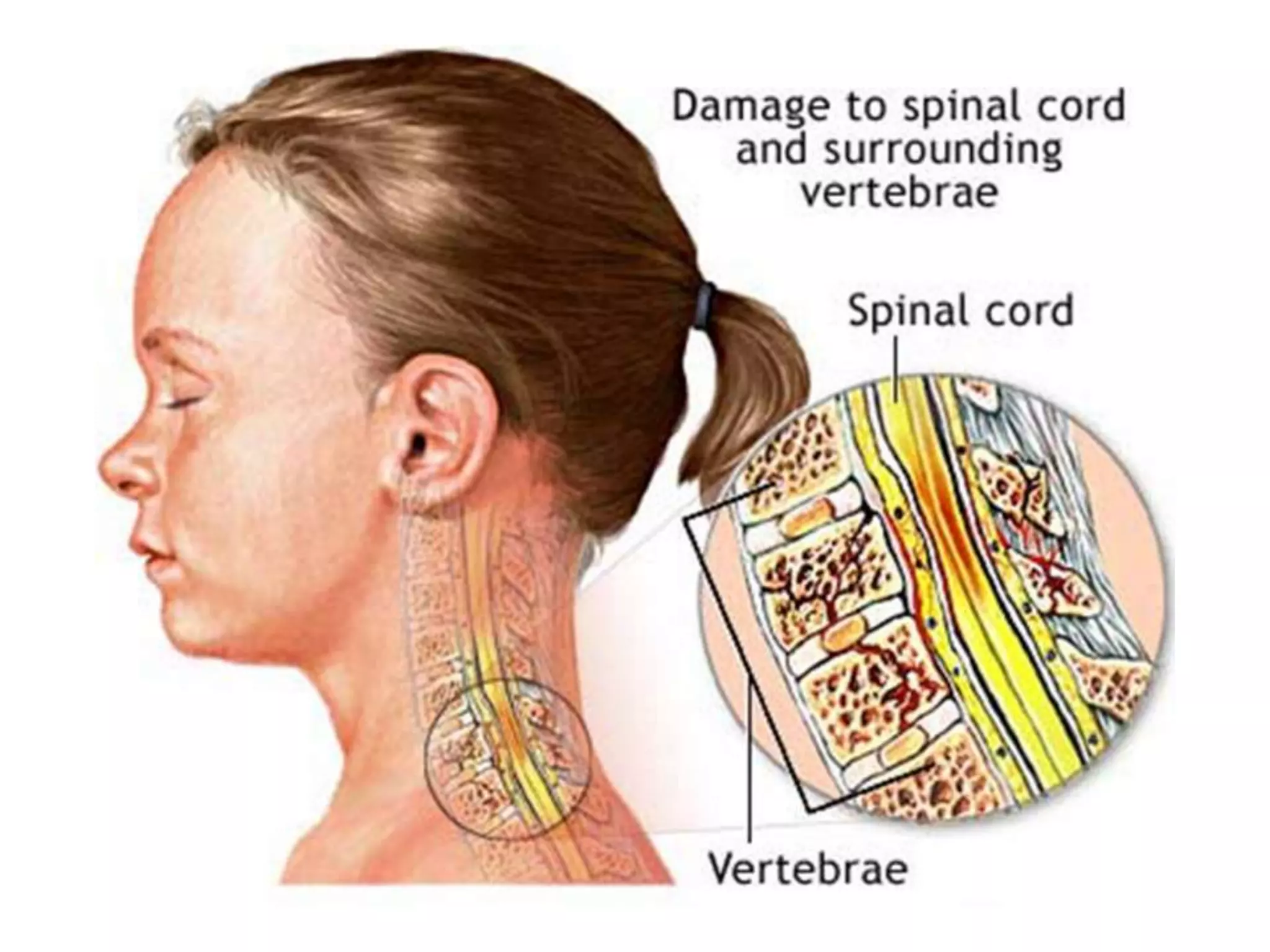 4. CNS Spinal cord injury.pptx