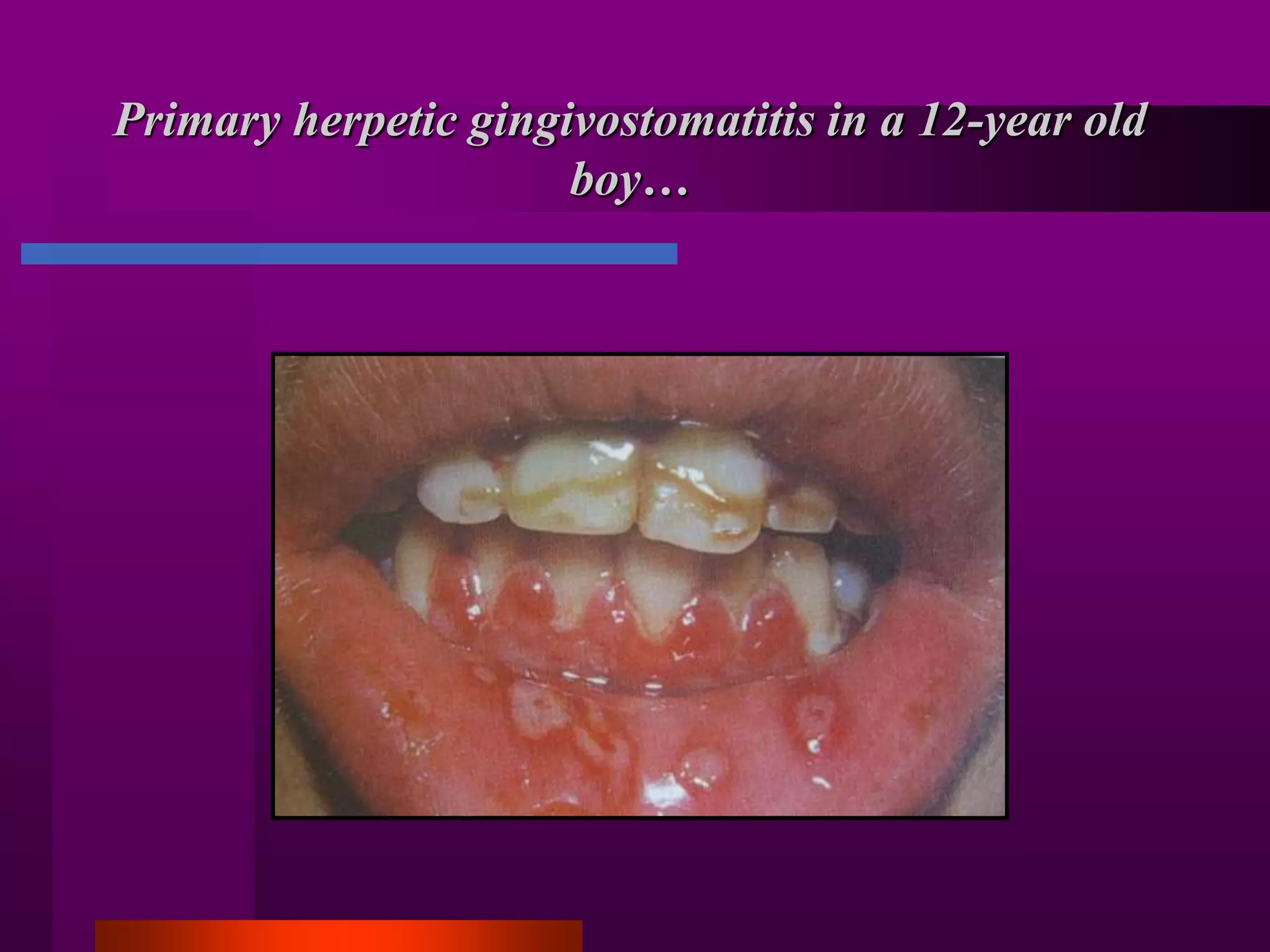 4.acute gingival infections.ppt