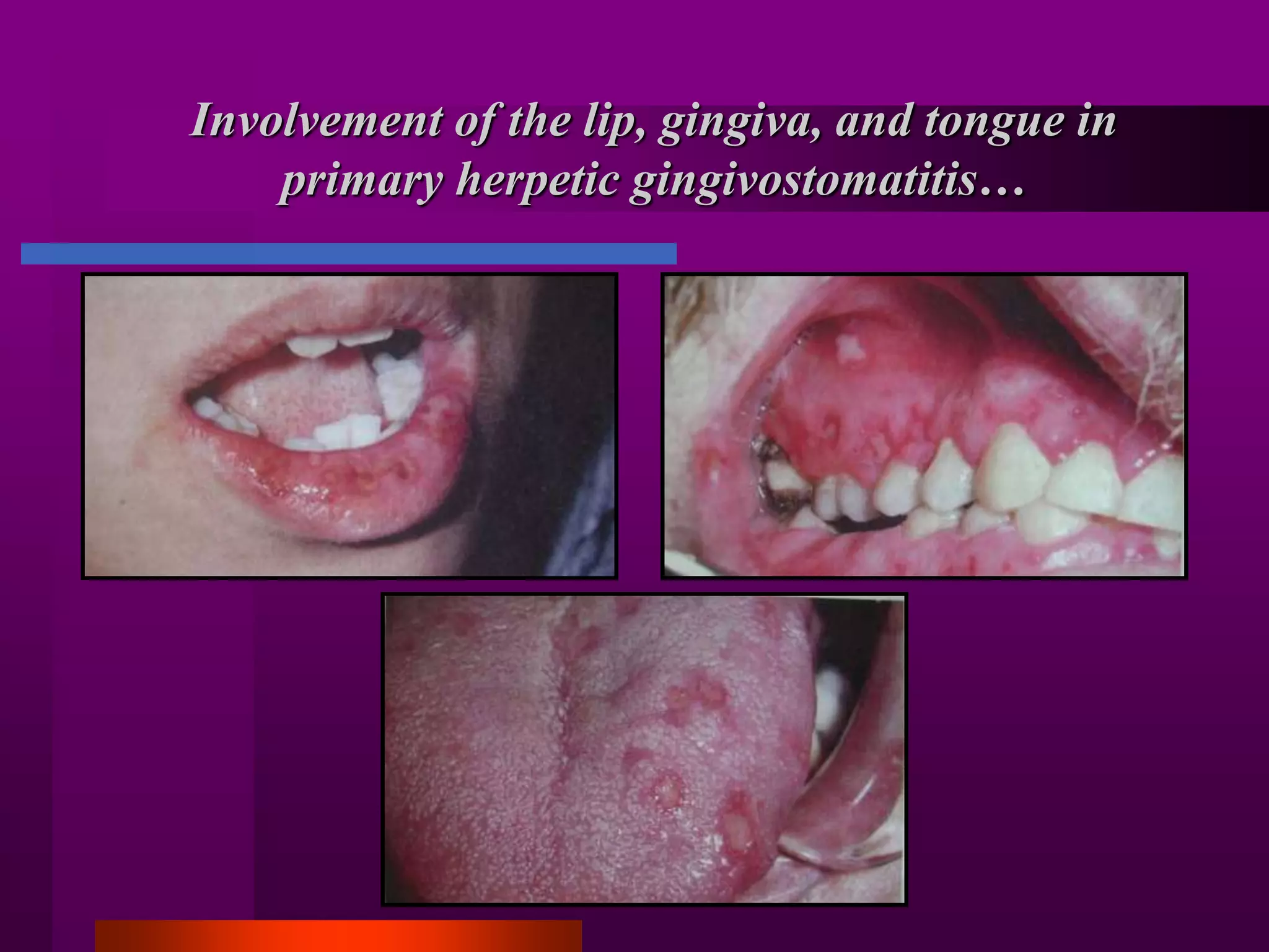 4.acute gingival infections.ppt