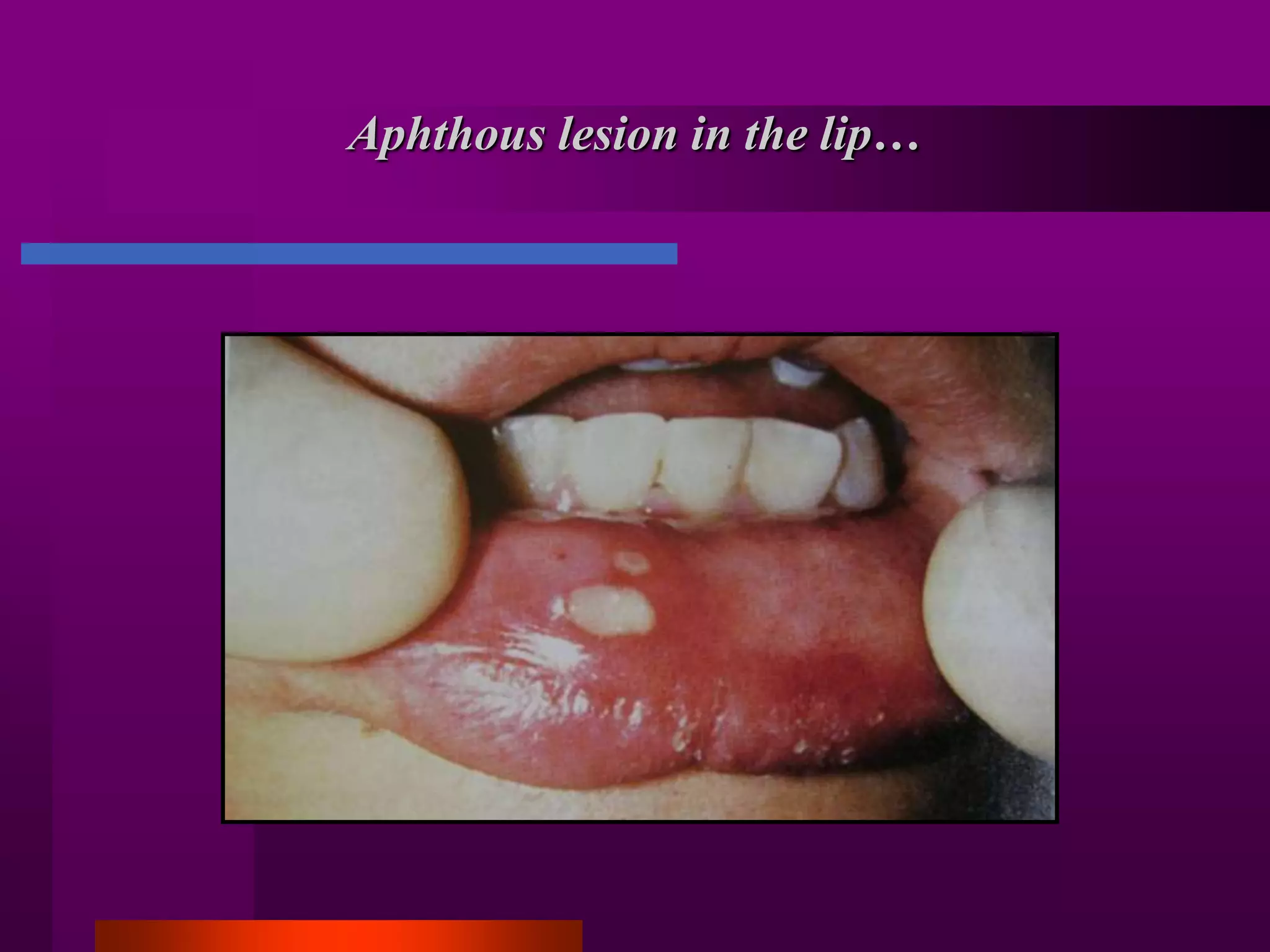 4.acute gingival infections.ppt