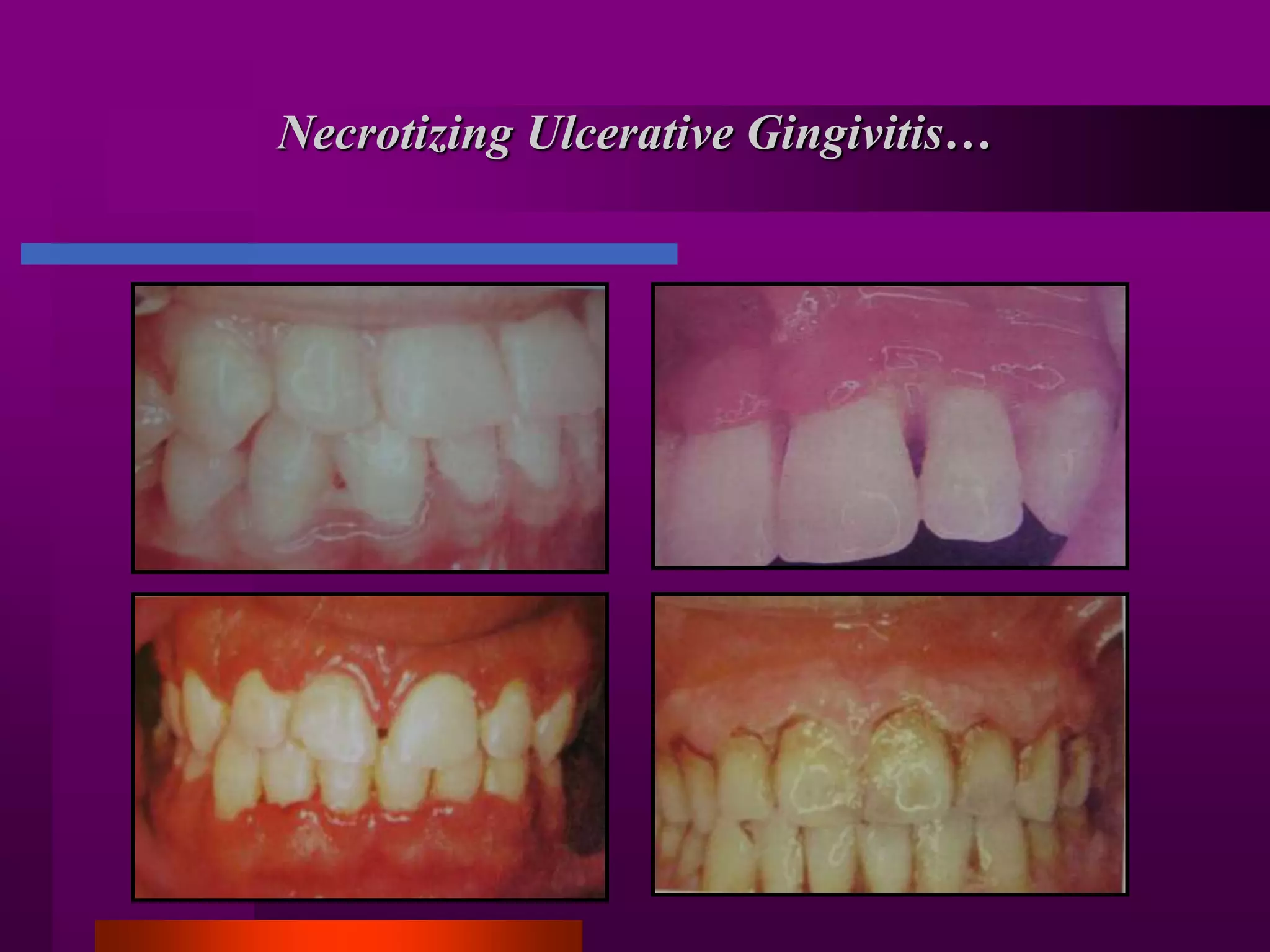 4.acute gingival infections.ppt