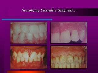 4.acute gingival infections.ppt