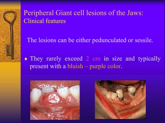 Giant Cell Lesions | PPT | Bone and Joint Conditions | Diseases and ...