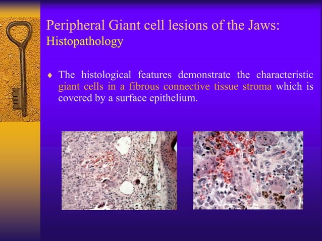 Giant Cell Lesions | PPT | Bone and Joint Conditions | Diseases and ...