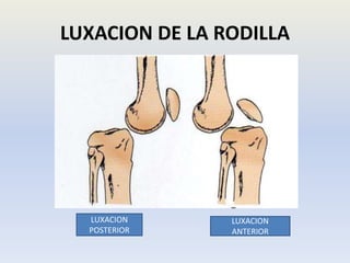 4. LUXACION DE RODILLA.pptx