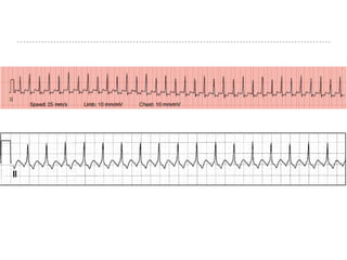 4. Impulse Abnormality.pdf