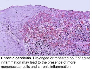 4. chronic inflammation.pptx