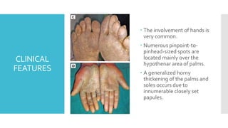 Darier's Disease | PPTX