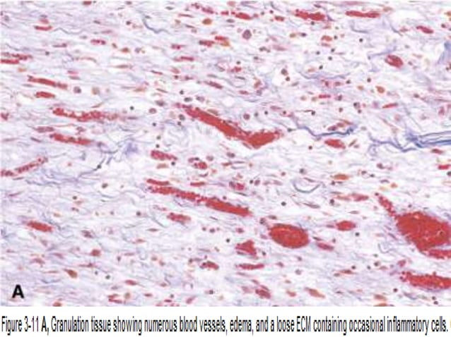 4. Pathology -midwifery stu-Tissue repair(1).ppt