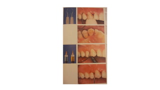 4.Chiuretaj pe câmp închis.,,,,,,,,,,pdf | PPT