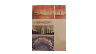 4.Chiuretaj pe câmp închis.,,,,,,,,,,pdf | PPT