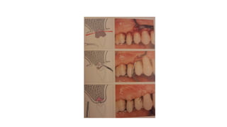 4.Chiuretaj pe câmp închis.,,,,,,,,,,pdf | PPT