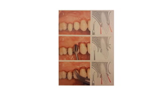 4.Chiuretaj pe câmp închis.,,,,,,,,,,pdf | PPT