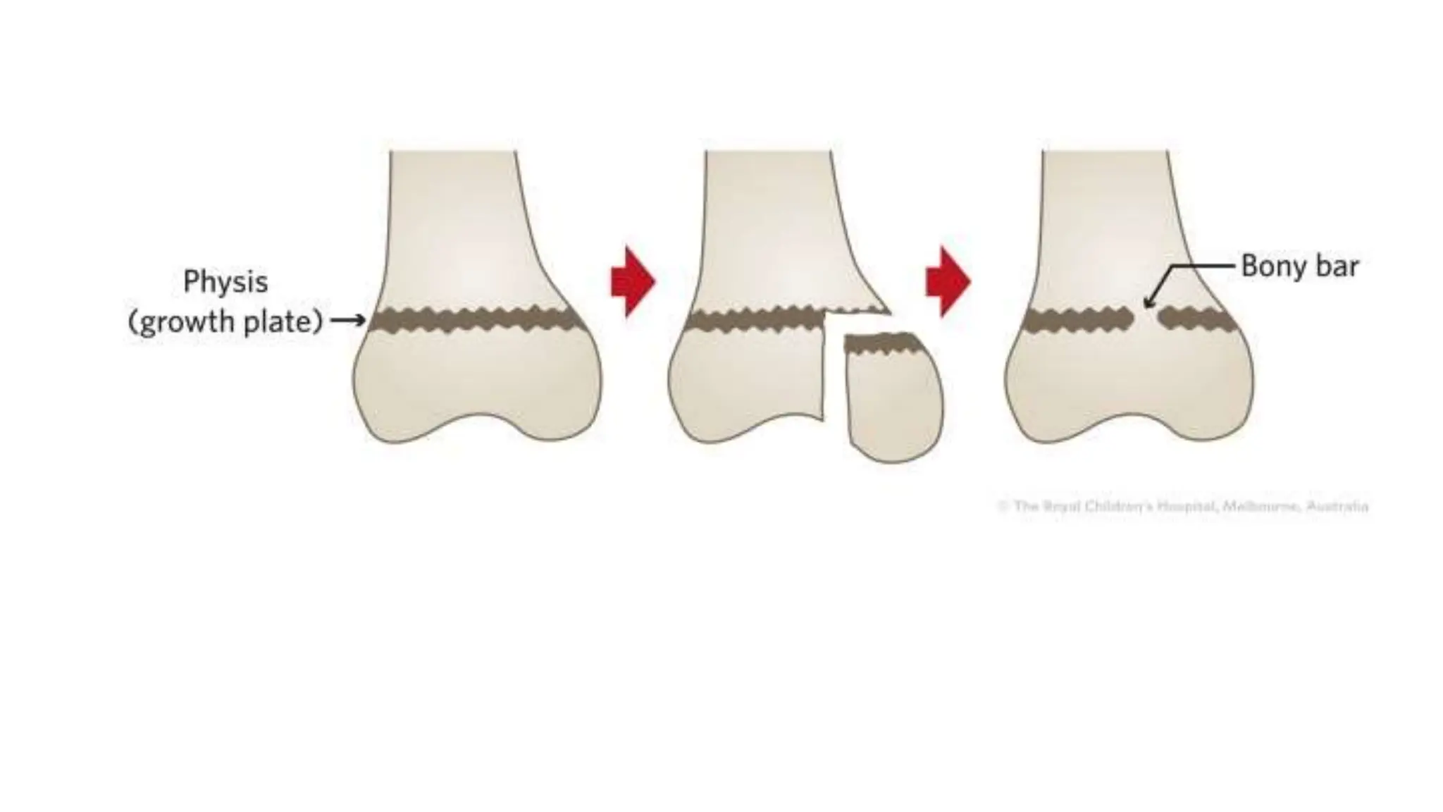 Understanding Bone Development and Disorders | PPTX