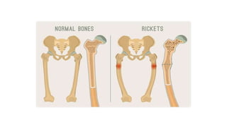 Understanding Bone Development and Disorders | PPTX