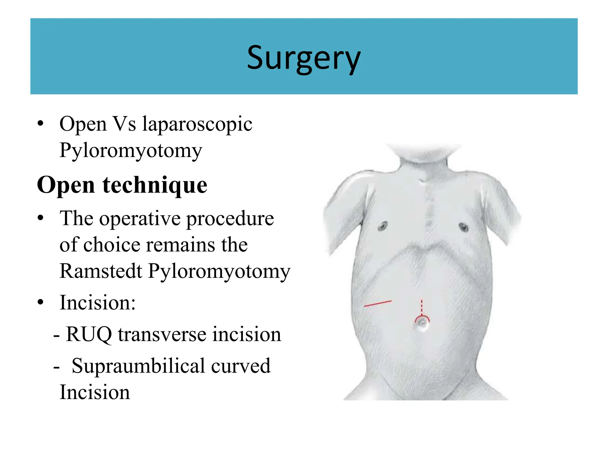 4.Management of IHPS and Intussusception.pptx
