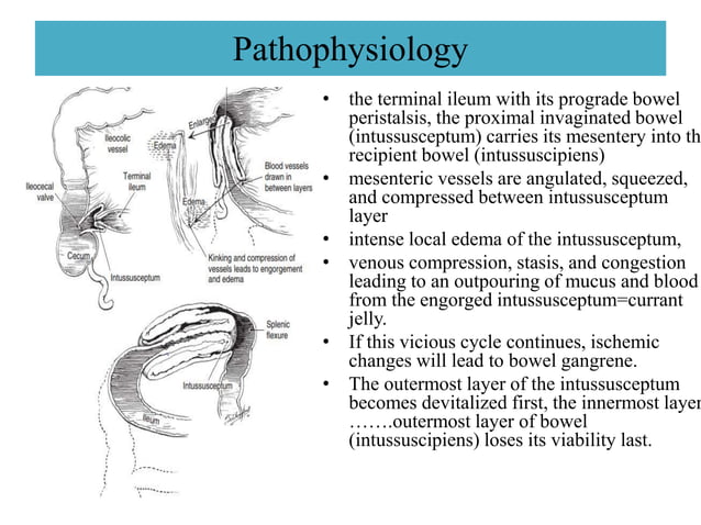 4.Management of IHPS and Intussusception.pptx