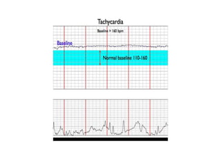 4. FETAL SURVEILENCE AND INTRAPARTUM FETAL MONITORING - Copy.pptx