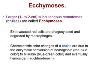 4. Hemodynamic disorders (Edema, Hemorrhage, thrombosis, embolism)(1).ppt