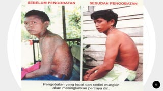 pengobatan penyakit kusta (morbus hansen) | PPTX