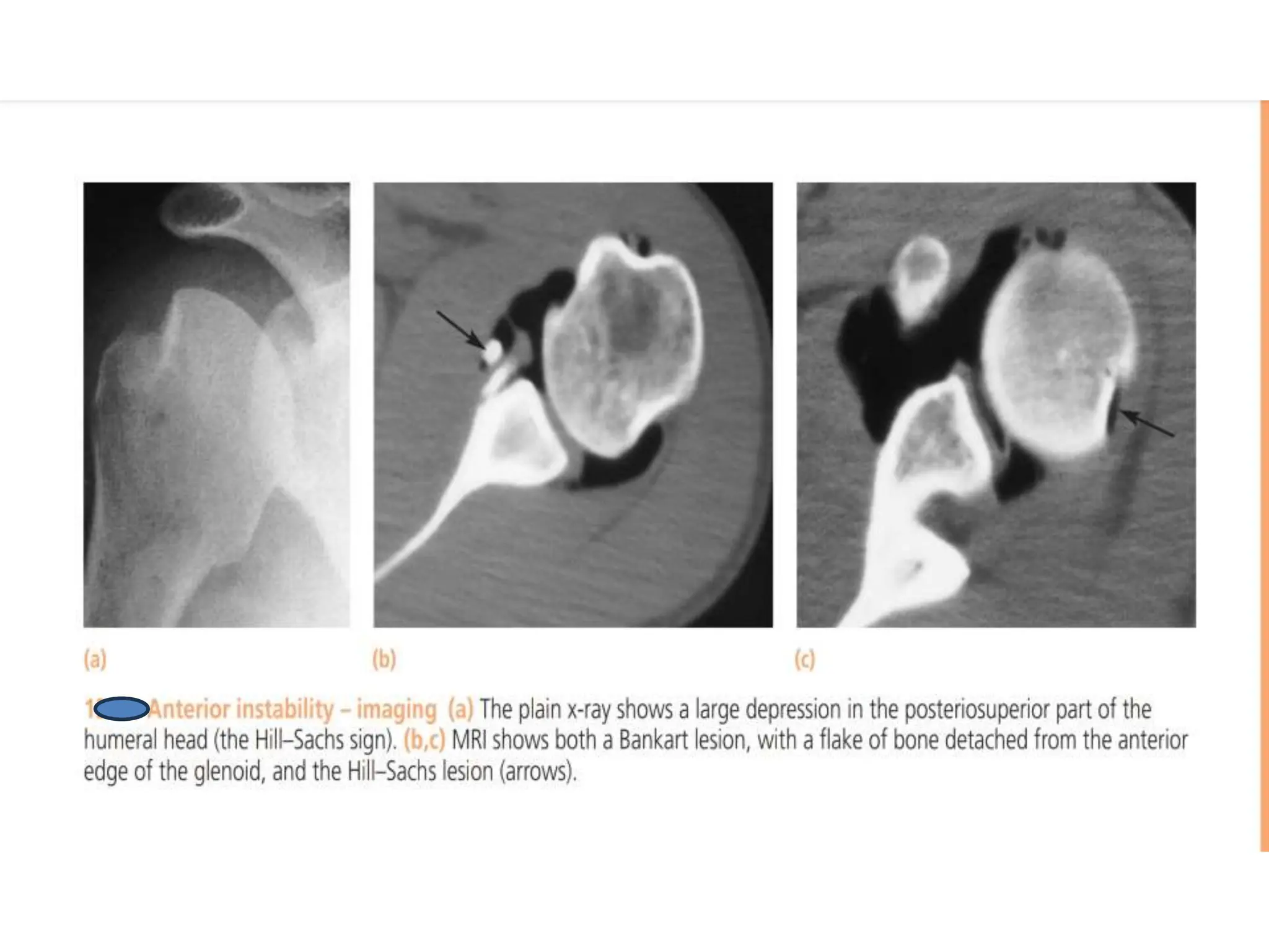 4. Acute Shoulder Dislocations cme ankit.pptx