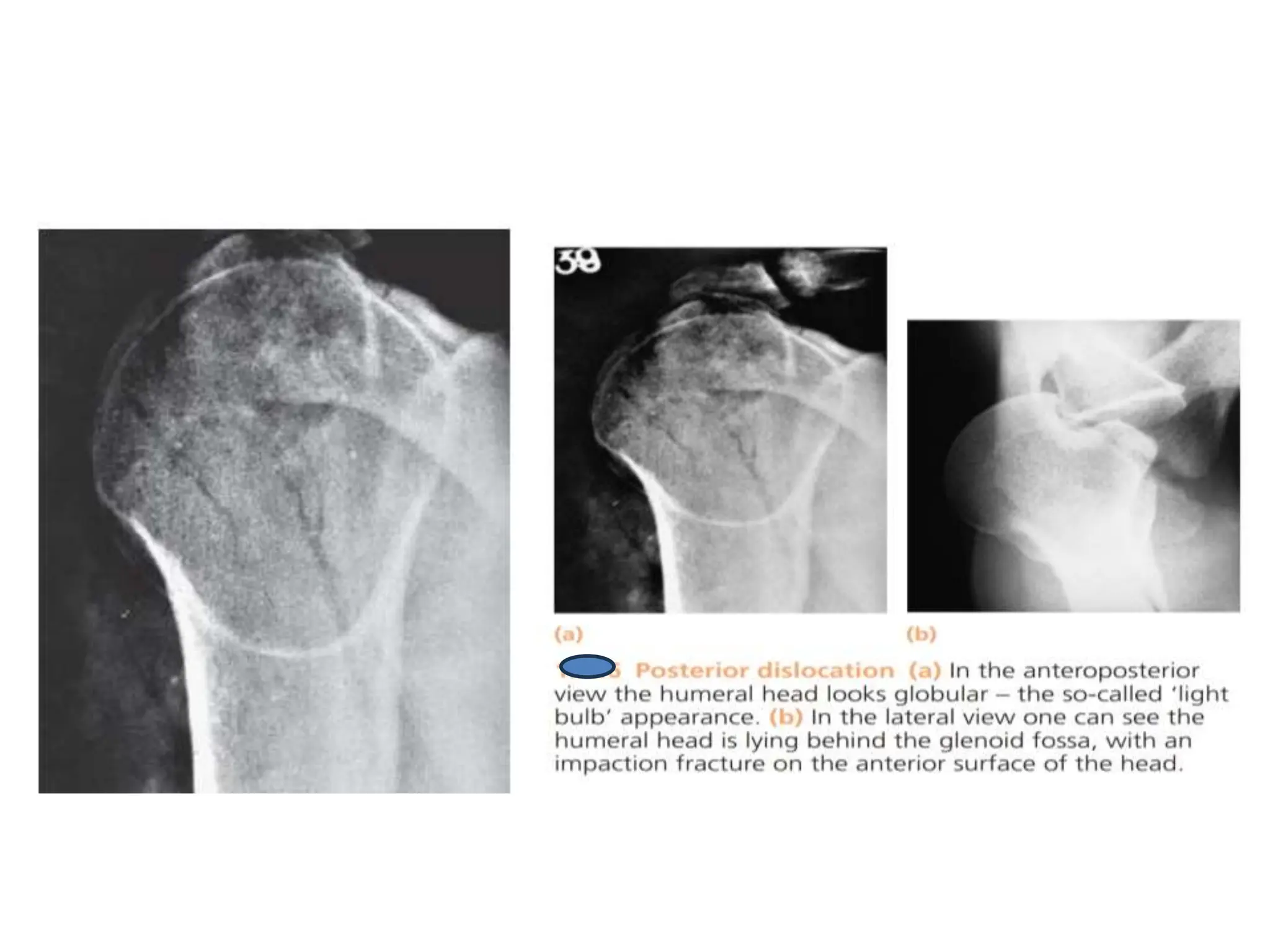 4. Acute Shoulder Dislocations cme ankit.pptx