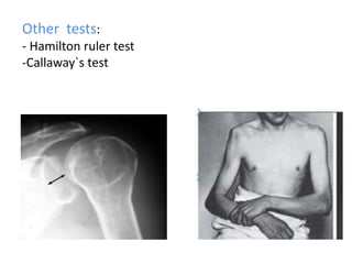 4. Acute Shoulder Dislocations cme ankit.pptx