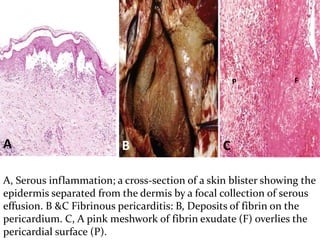 4._Morphologic_Patterns_&_Outcomes_of_Acute_Inflammation.pptx